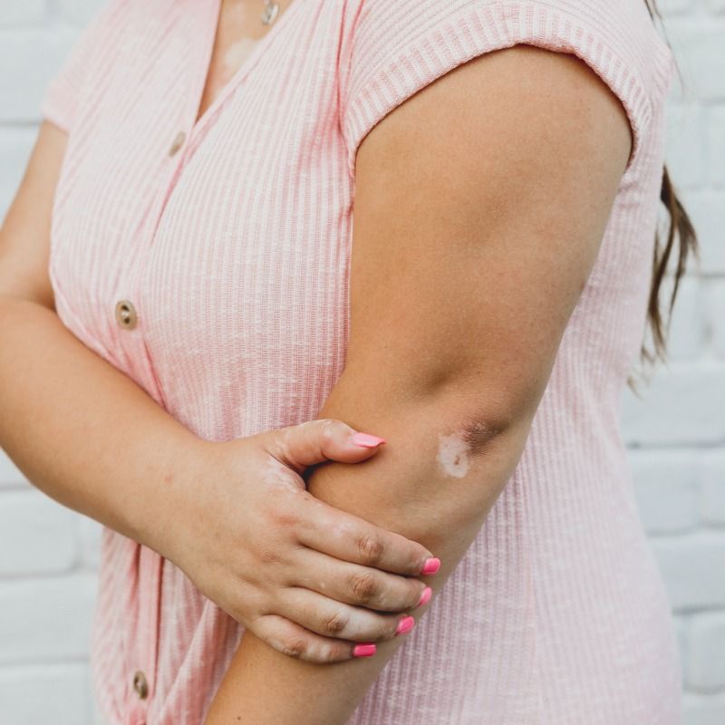 Living Dappled | Vitiligo Blog and Lifestyle Guide