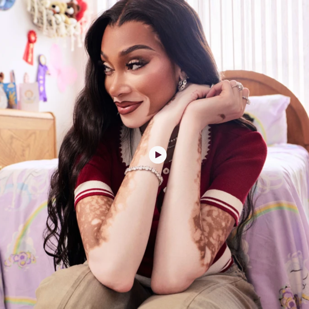 The Winnie Harlow Moment That Made Me Cry - Living Dappled